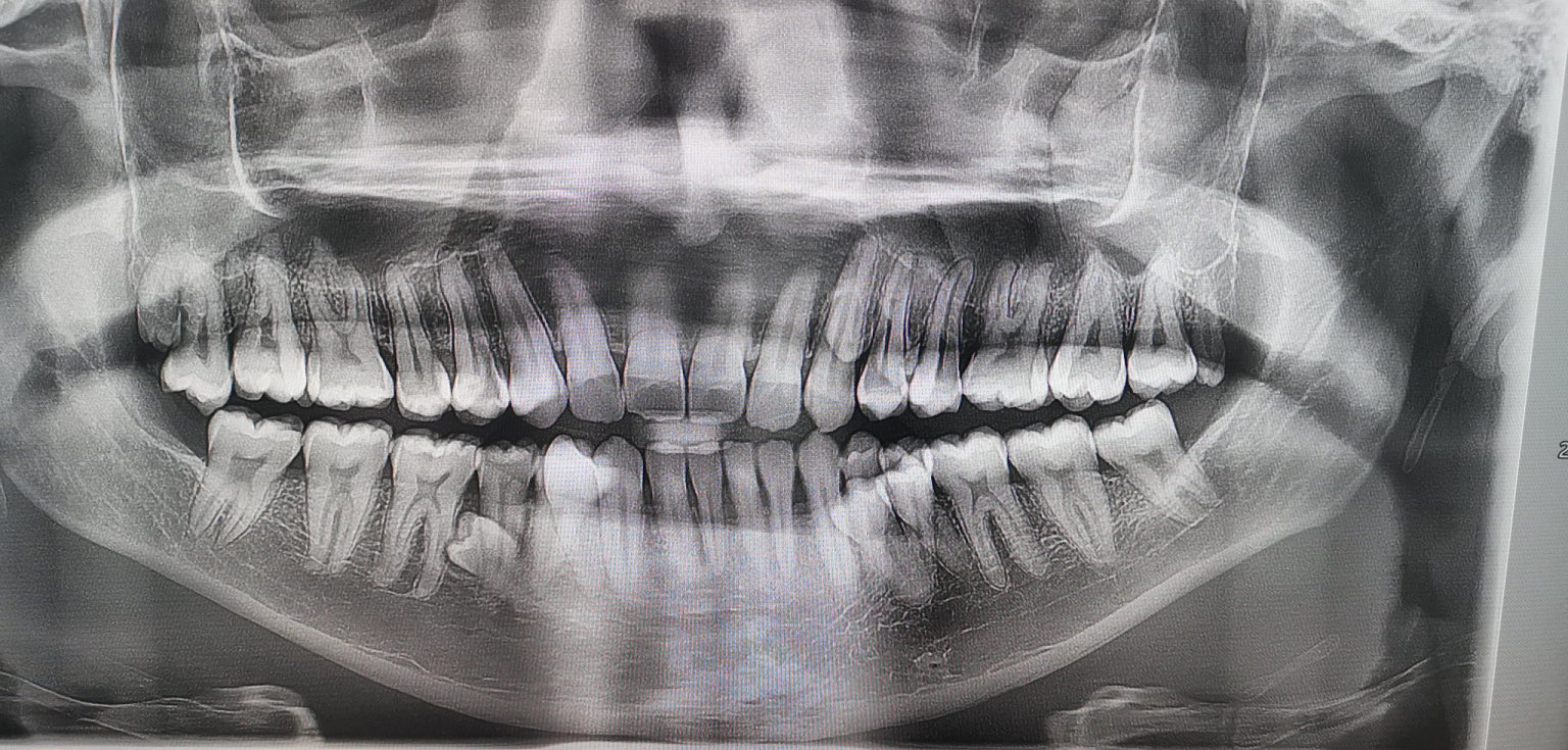 M'sian man with 42 teeth sets new Guinness World Record for the most ...